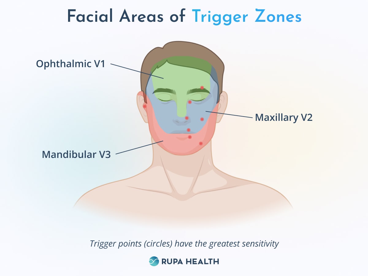 Trigeminal Neuralgia Trigger Points